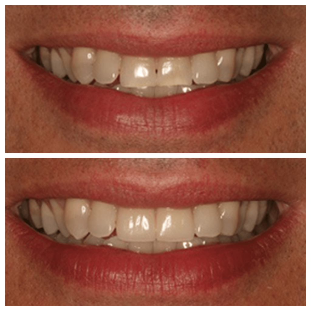 Ceramic Veneers | Porcelain Veneers | Broken Teeth | New York City, NY