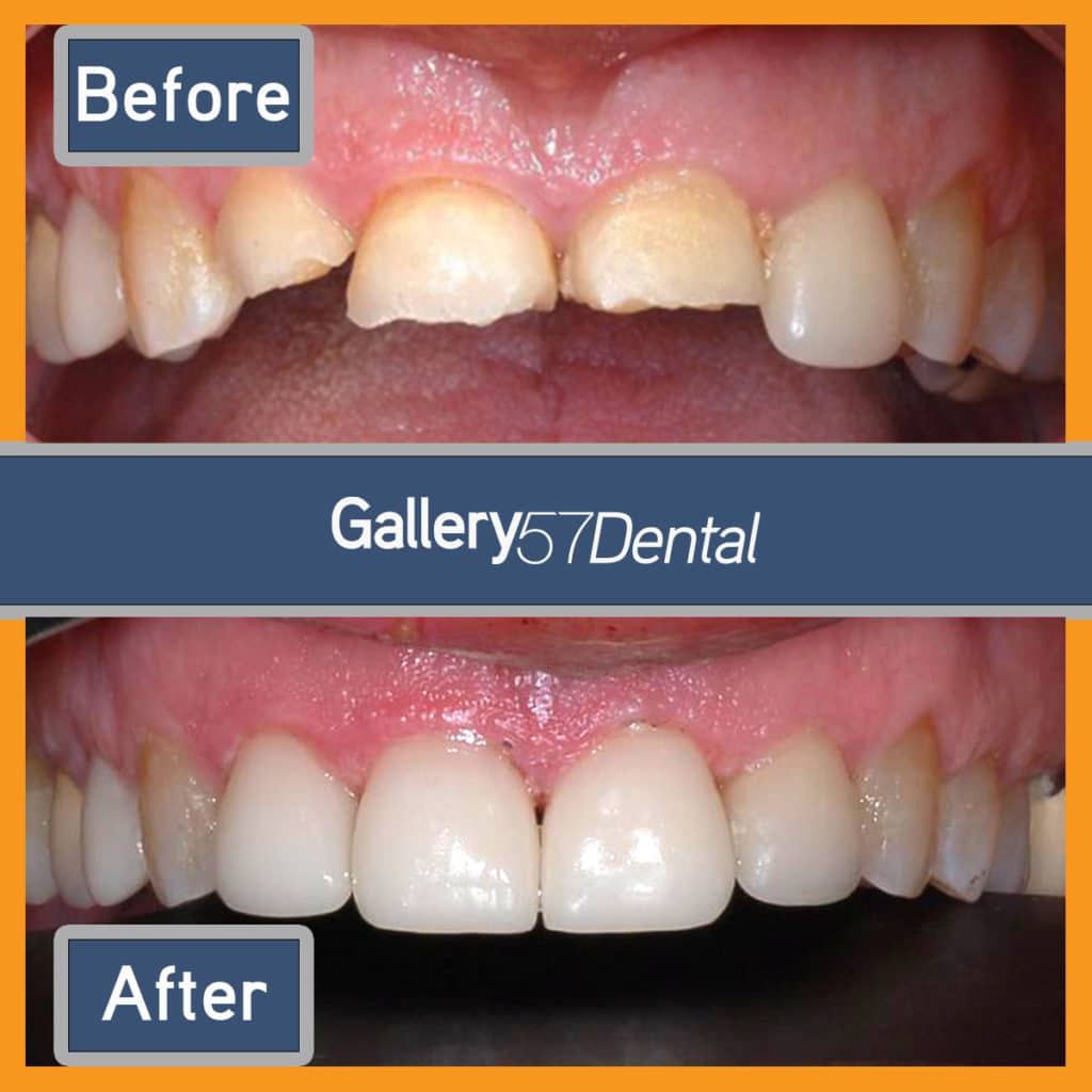 I Broke My 3-Front Teeth! Now What? - Gallery57Dental