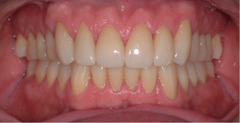 Michael's 12-Crown Smile Makeover - Gallery57Dental