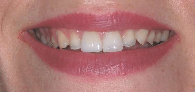 Experience The Magic - Gallery 57 Dramatic Smile Transformation