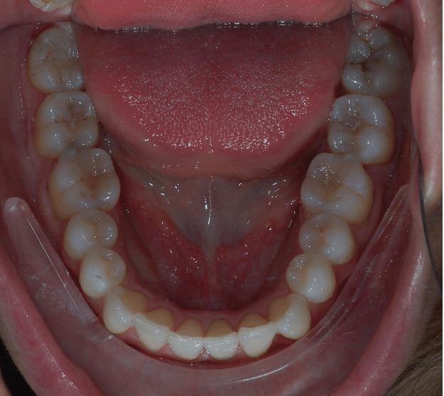 A Pre-Wedding Dental Transformation - Gallery 57