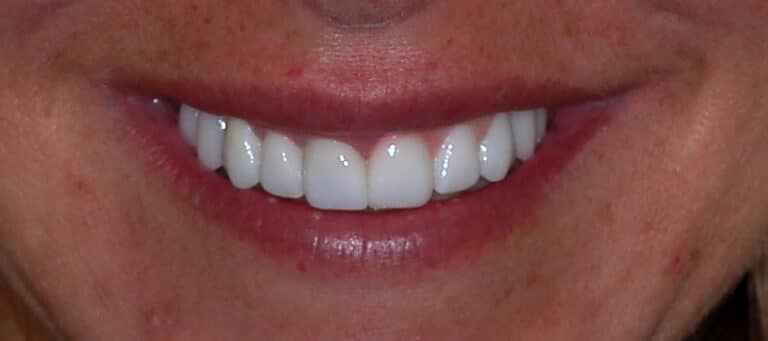 Dental Bridge for a Gap-Toothed Smile - Gallery 57