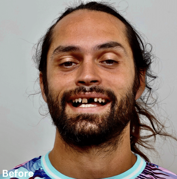 Missing Front Tooth Perfectly Restored - RayFace 3D Scanner